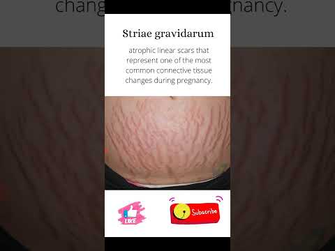 Striae gravidarum