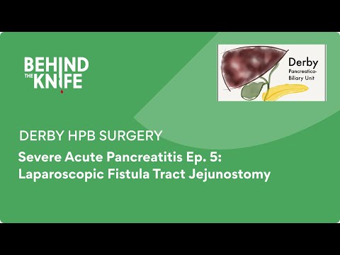 Derby HPB Surgery - Severe Acute Pancreatitis Ep. 5: Laparoscopic Fistula Tract Jejunostomy