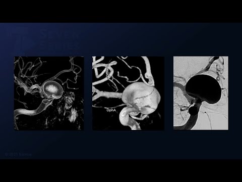 Retrograde Suction Decompression for Clipping of a Giant Ophthalmic ICA Aneurysm