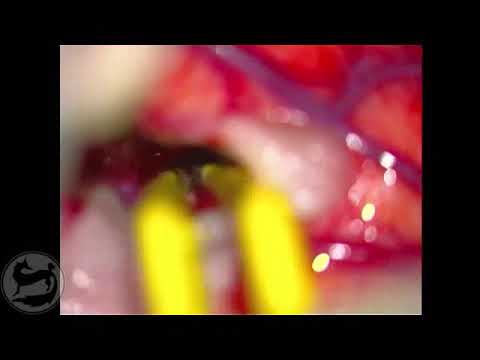 Video Left Superior Temporal Sulcus Cavernoma Youmans and Winnβ¦