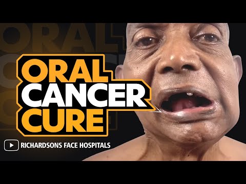 Oral Cancer Cure | Hemi mandibular resection,  neck dissection and PMMC flap reconstruction in india