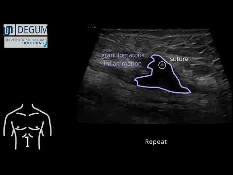 Episode 43: Suture granuloma