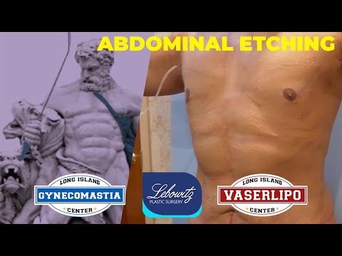 6-PACK ABS ETCHING💪🏼 4D Dynamic Hi-Def Vaser POWER 🏋️♀️ LipoSculpture by Dr. Lebowitz