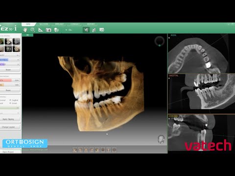 Vatech Smart Plus 12x9 – дентальный компьютерный 3D-томограф с ...