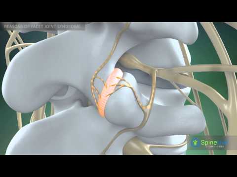 Facet Joint Syndrome Reasons