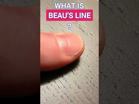 What is Beau’s Line on nail and its causes #shortvideo #shorts #reels #reel
