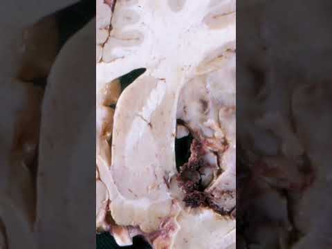 Glioblastoma - Pathology #shorts