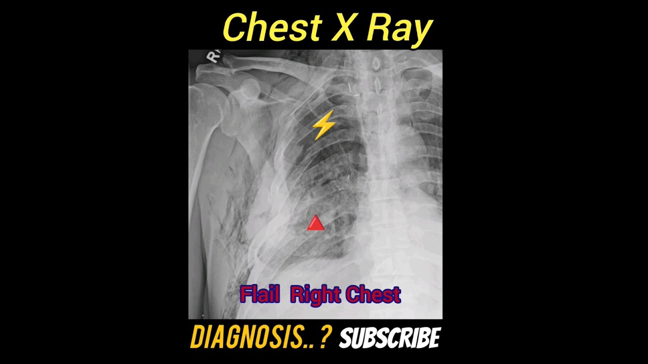 Flail chest - Diagnosis ? CXR PA- Practical case - Radiology