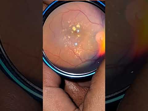 DRUSENS | MACULAR DEGENERATION | RETINA #eyehospital #ophthalmology