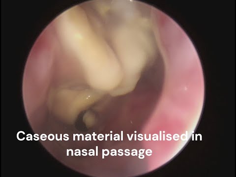 Rhinoscopy in a dog with a fungal infection - turbinate destruction and exposure of frontal sinus