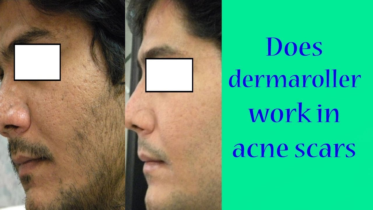 Does Dermaroller Work in Acne Scars? | Dr. Rinky Kapoor