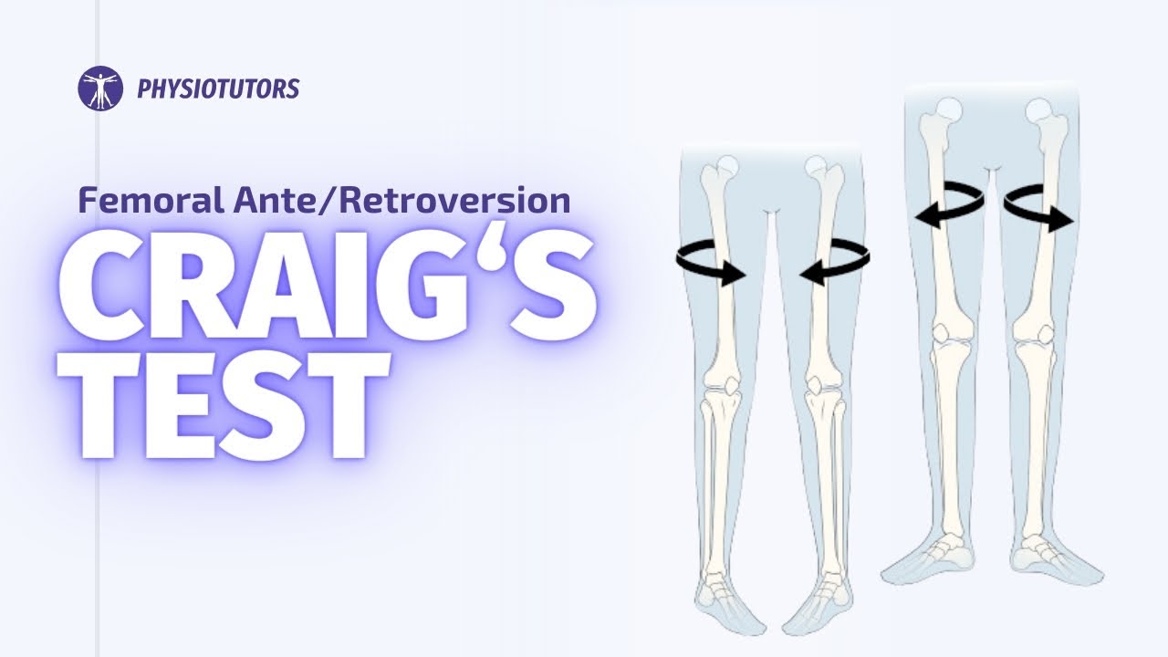 Craig's Test | Femoral Anteversion