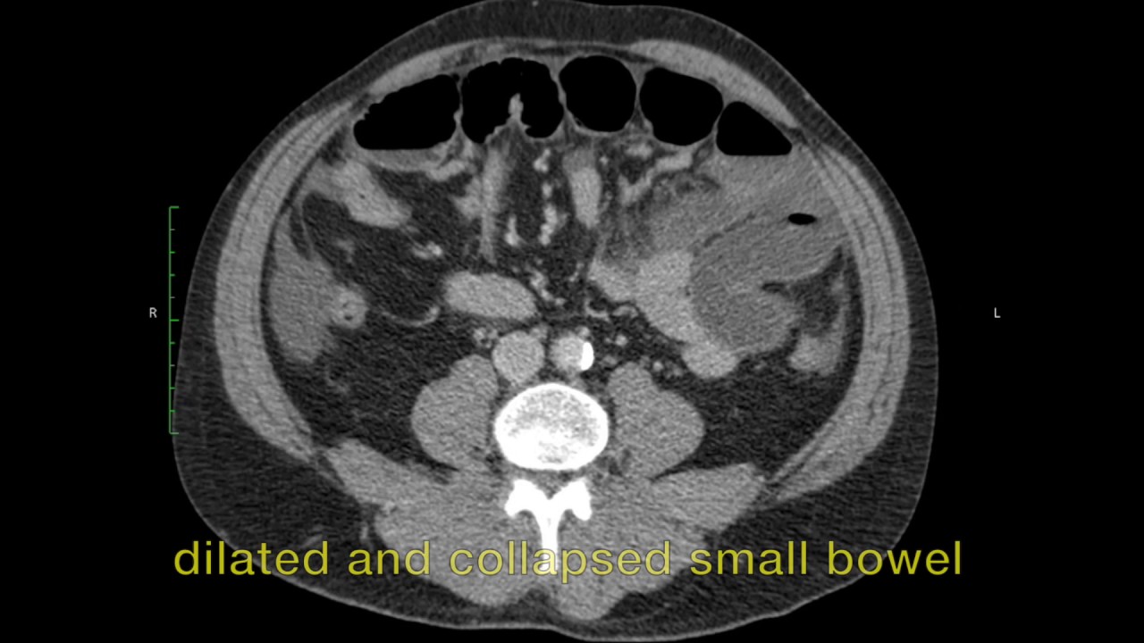 Closed loop two stenoses