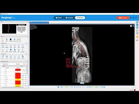 Surgimap Desktop Software - Sagittal Alignment Wizard