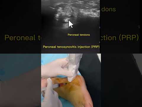 Peroneal tendon injection (PRP)