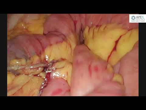 Laparoscopic Roux En Y hepaticojejunostomy #apexhospital #painlesssurgery #gallbladderproblems