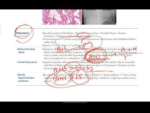 Sleep Apnea | Respiratory # 24 | First Aid USMLE in Urdu/Hindi
