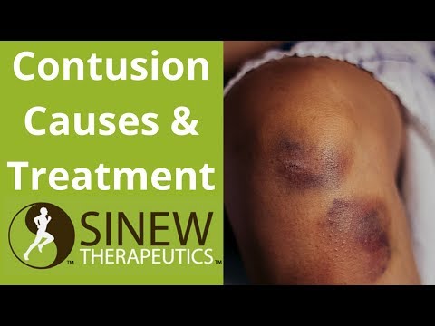 Contusion Causes and Treatment
