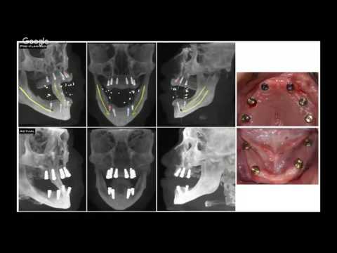 Digital Smile Design Integration With Blue Sky Plan (Dr Marko Tadros)