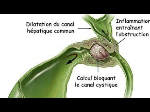 SCANNER ABDOMINO-PELVIEN  (cholécystite alithiasique , Hépatomégalie homogène )