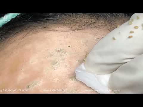 Big Cystic Acne Blackheads Extraction Blackheads & Milia, Whiteheads Removal Pimple Popping