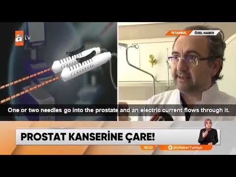 Patient Testimonial with a Successful Nanoknife Treatment