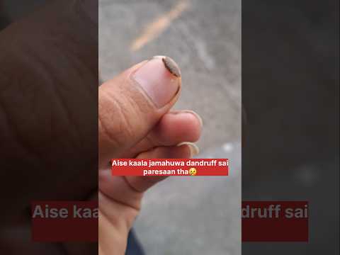 Treat oily dandruff in just 30sec๐ฎ๐ฅ #dandruff
