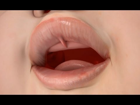 Upper Lip Tie Release Treatment