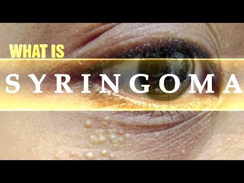 What is Syringoma? | Usapang Pangkalusugan
