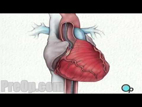 Balloon Angioplasty Coronary Angioplasty - PreOp® Patient Education Medical HD