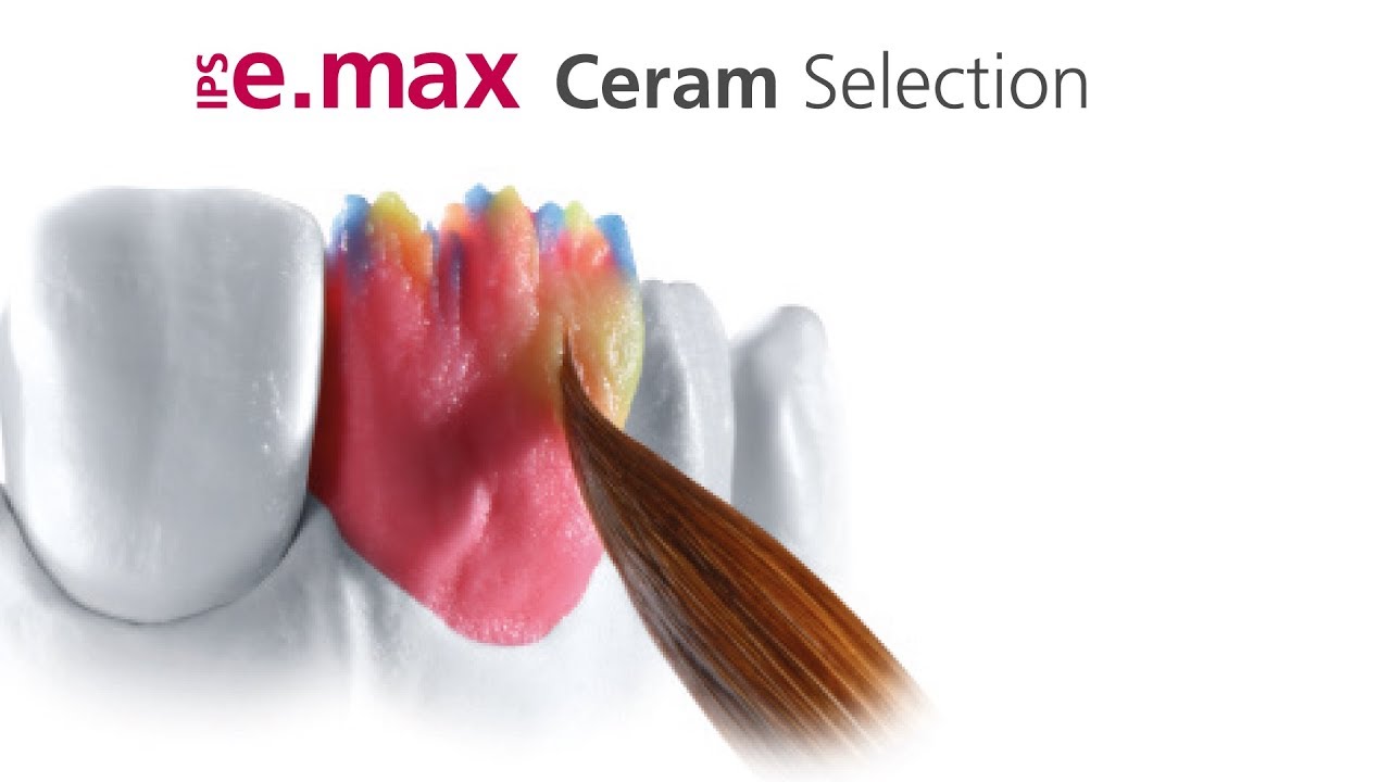 IPS e.max Ceram Selection