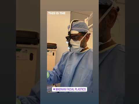 Facial fat transfer in progress #drmadnani #faceliftsurgery #cosmeticsurgery