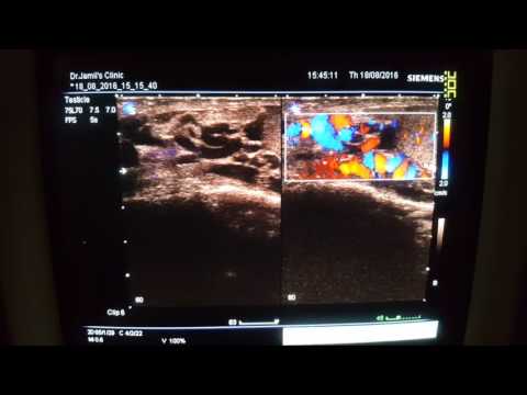 Varicocele ultrasound
