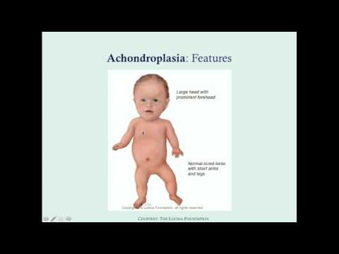 Achondroplasia - CRASH! Medical Review Series