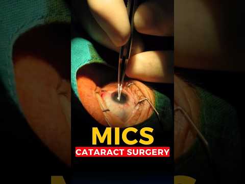 Live MICS Cataract Surgery