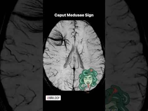 Caput Medusae sign -Developmental Venous Anomaly