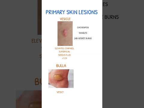 SKIN LESIONS Vesicle Vs Bulla