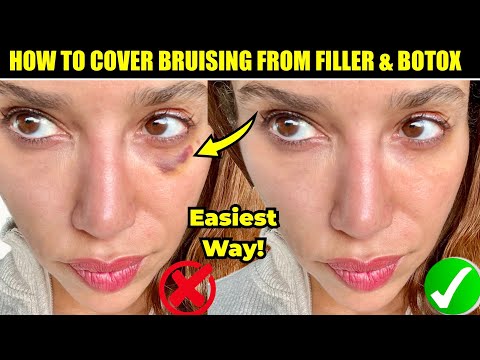 How to Cover Bruising from Fillers and Botox-The Easiest Way!