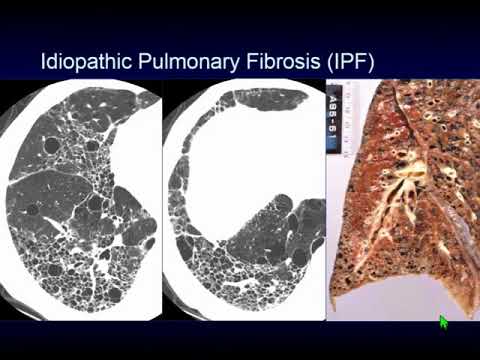 Interstitial Lung Disease