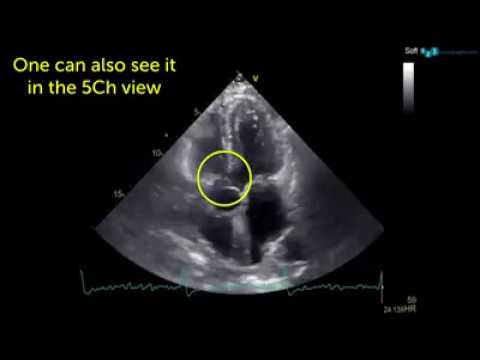 60 Sec Case Roots - Sinus valsalva aneurysm