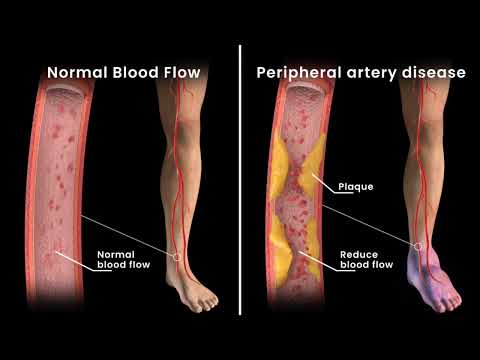 Peripheral Artery Disease Angioplasty
