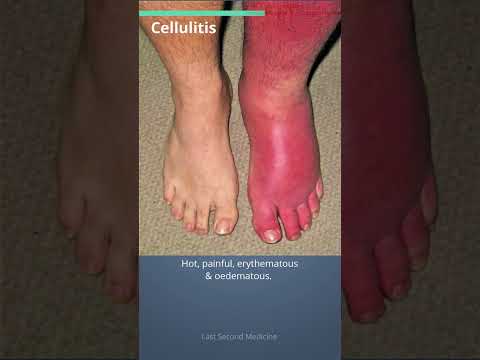 Learn in easy way about Cellulitis & its treatment? #shorts