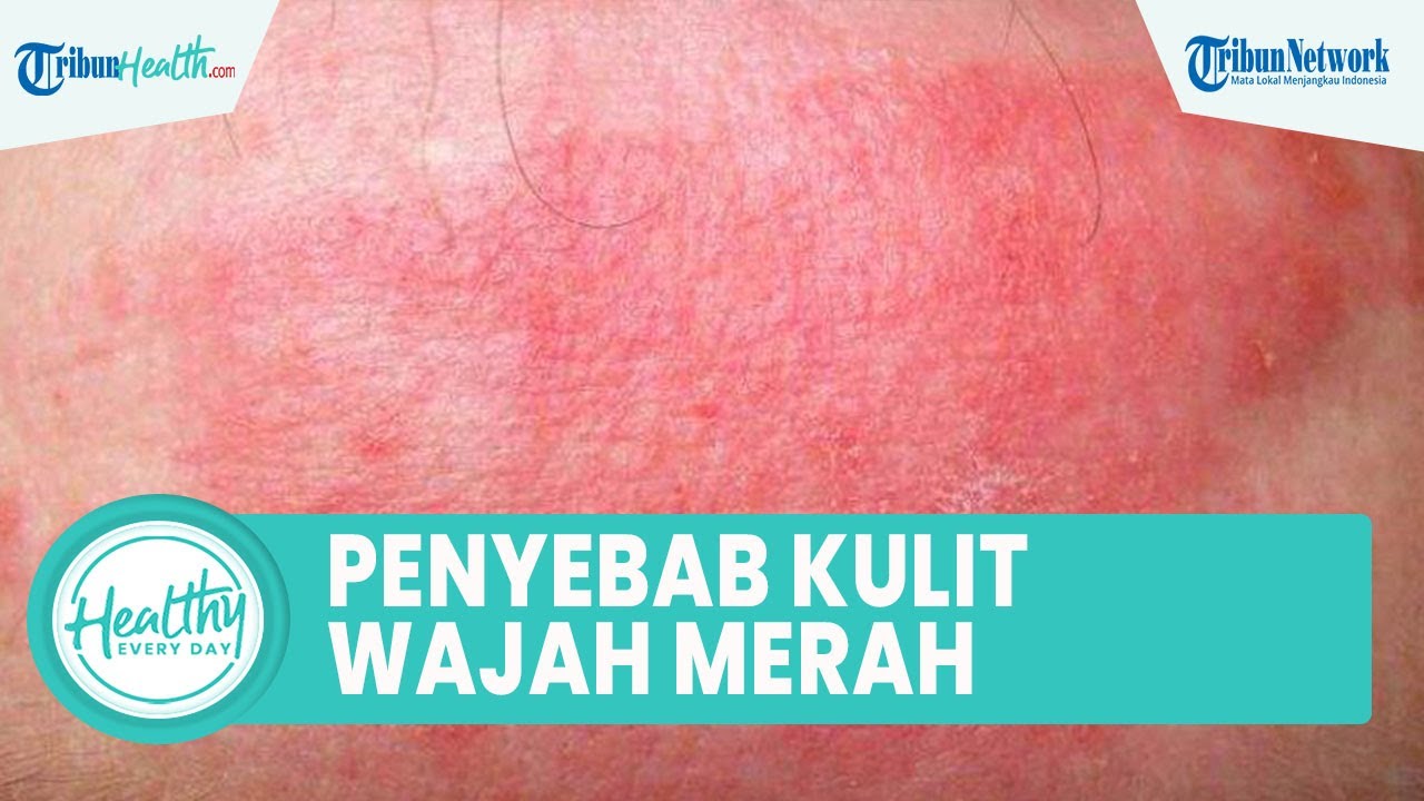 Kulit Wajah Merah Meradang akibat Rosacea, Berikut Ini Gejala Penyebab ...