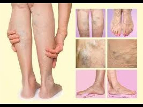 Varicose Veins In Urdu (What are varicose veins in urdu) #TalksWithDoctorD
