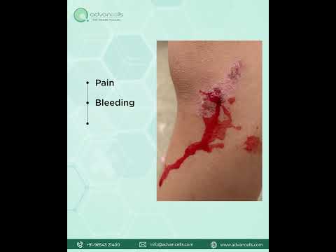 Symptoms of Skin Abrasions | Advancells Stem Cell Therapy