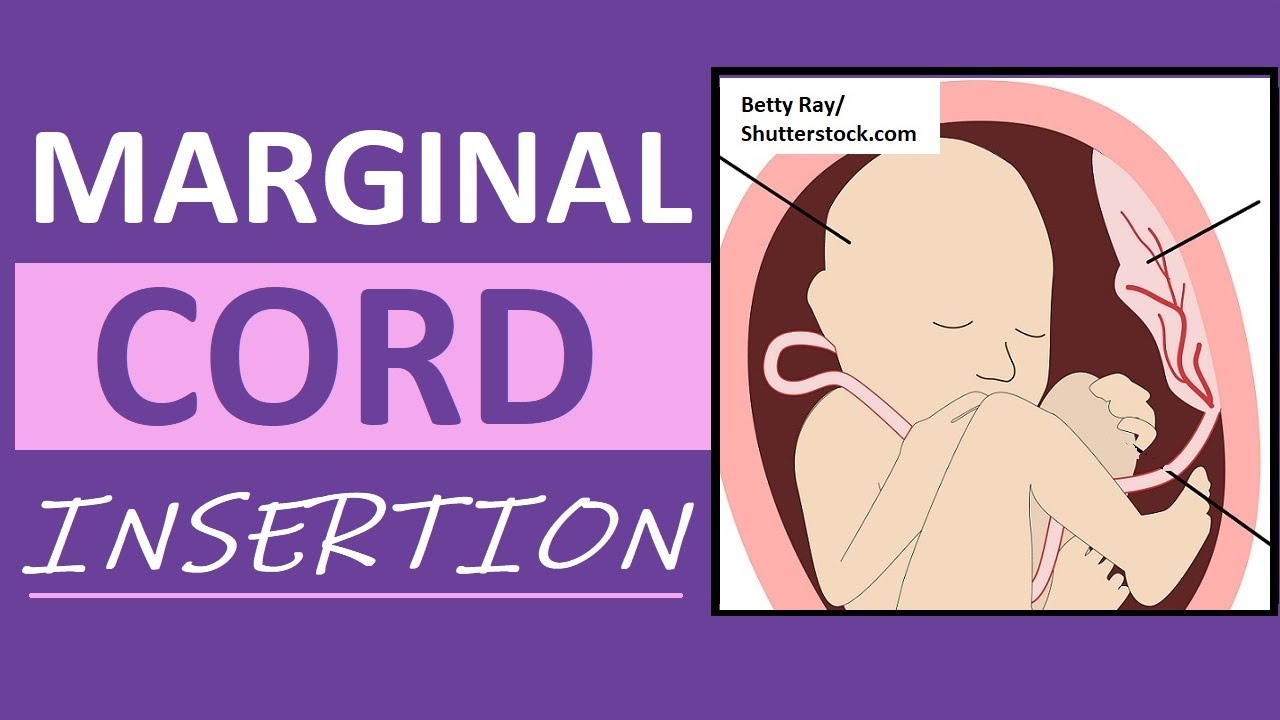 Marginal Cord Insertion Placenta Experience | Pregnancy Birth Vlog