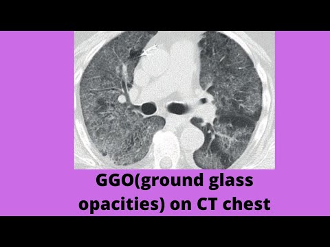 ground glass haze on CT chest