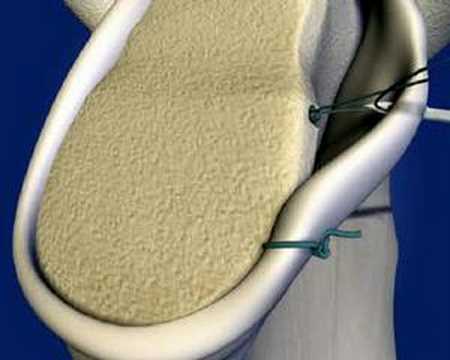 Shoulder Surgery: Torn Labrum | ren3gade