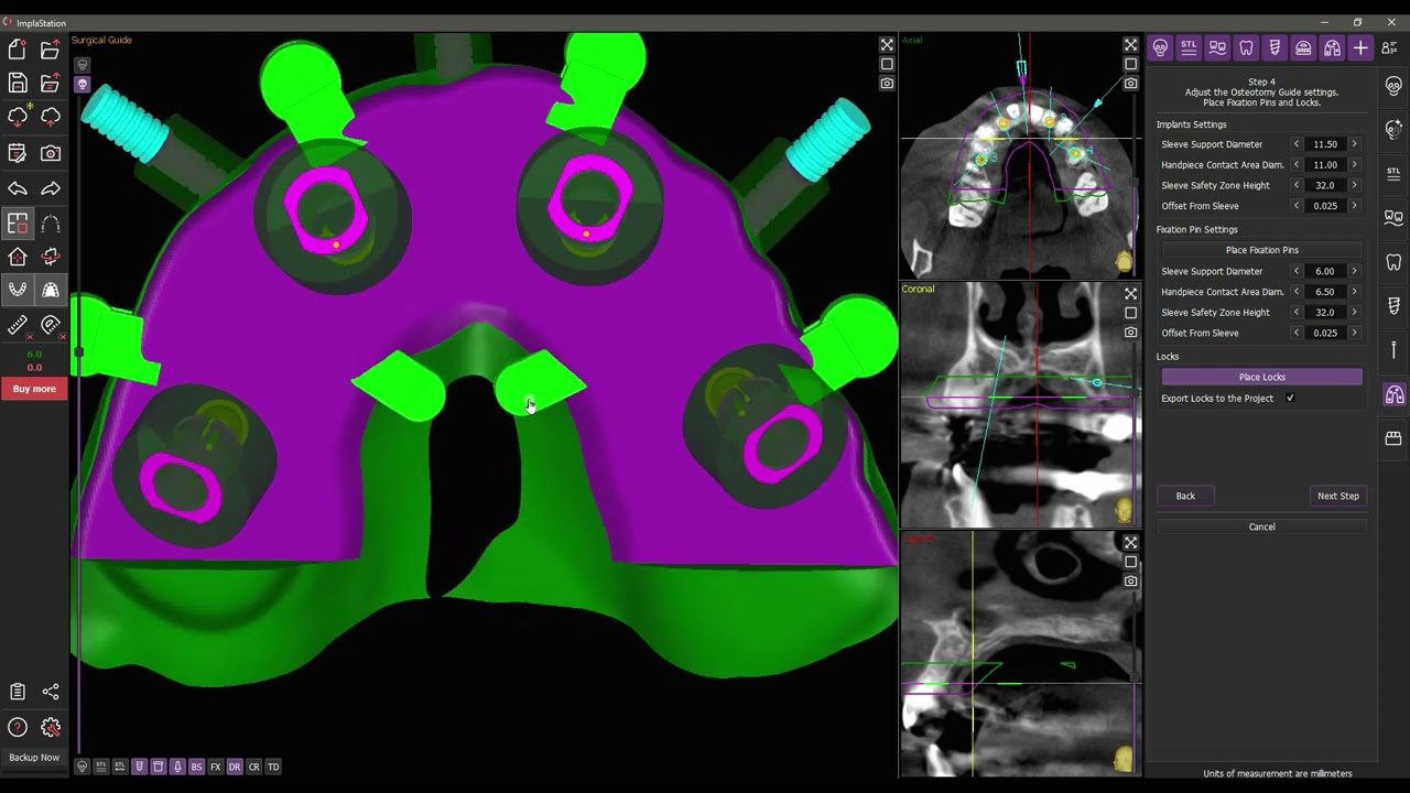 Stackable Surgical Guide design (case with bone reduction and immediate loading)