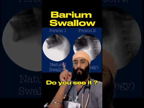 Live Swallowing X-rays | Fluoroscopy